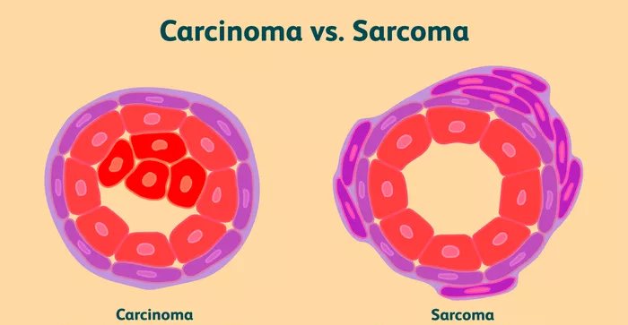 CARCINOMA AND SARCOMA: THE DIFFERENCE I Kosheeka